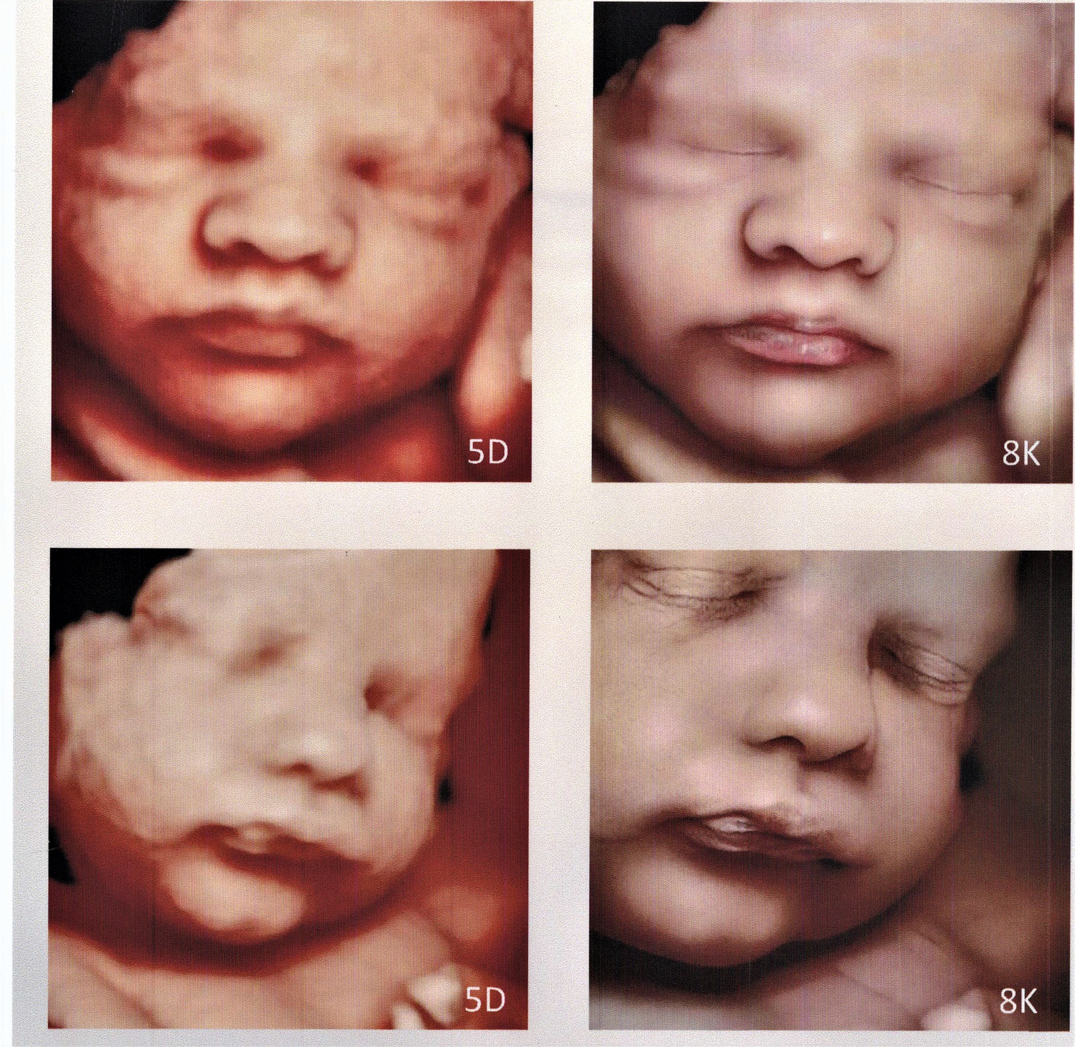 3d Ultrasound Rendering Cranial Development In The First Trimester: