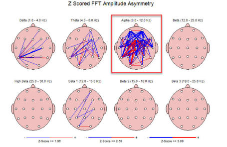 Depression Treatment, NeuroField Neurotherapy, Santa Barbara