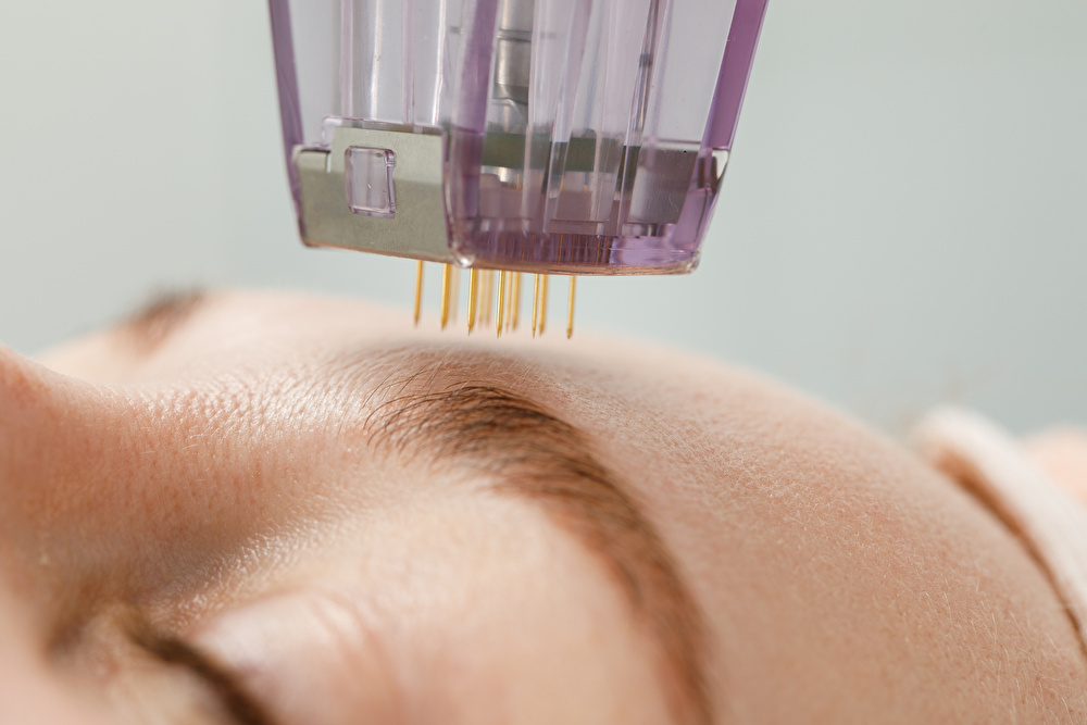What is Radiofrequency Microneedling? | MOBO Med Spa