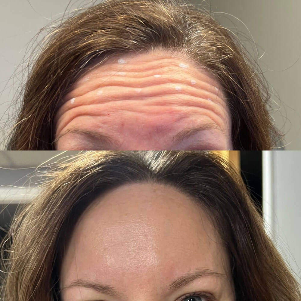 Forehead-lines-MOBO-Med-Spa3