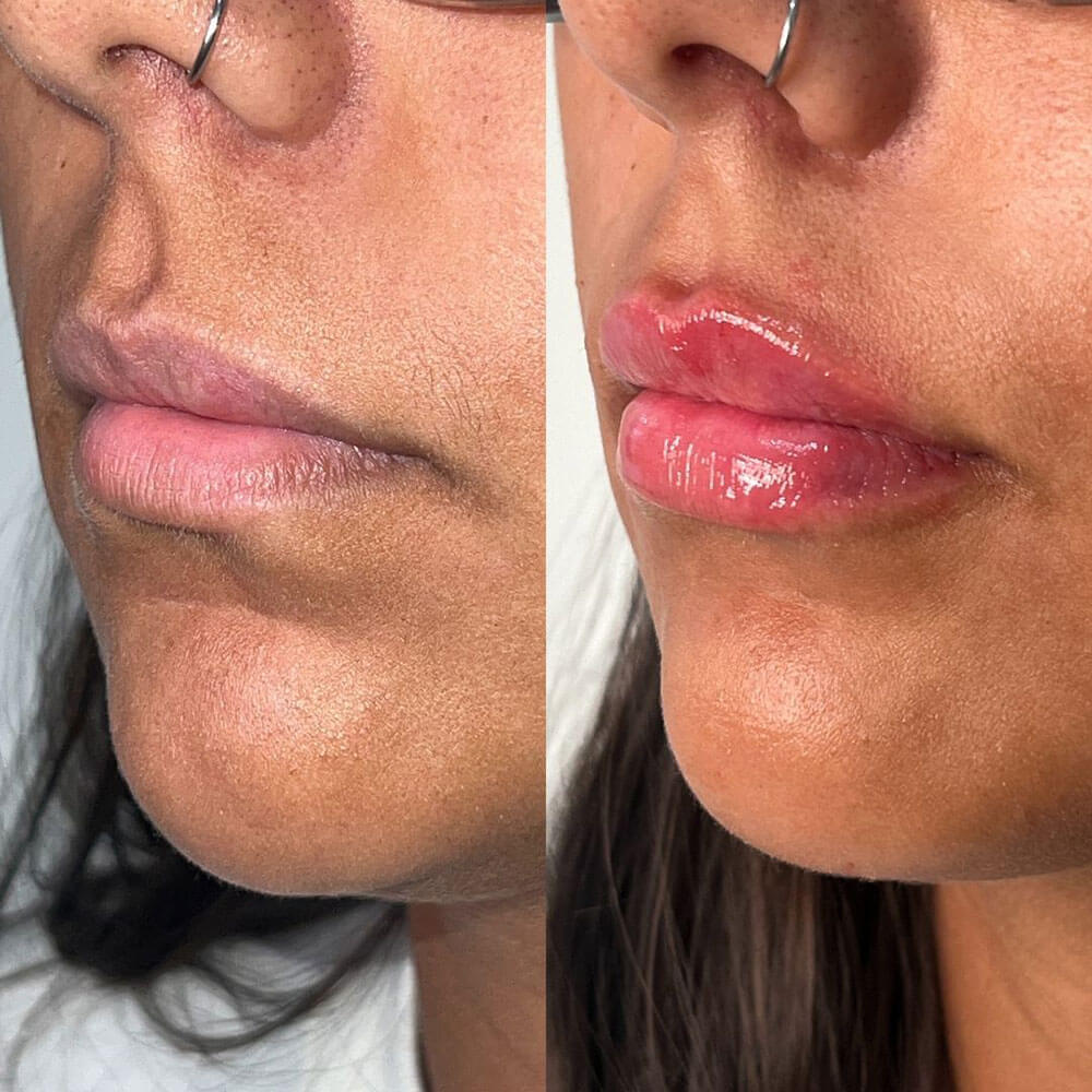 Lip-Filler-MOBO