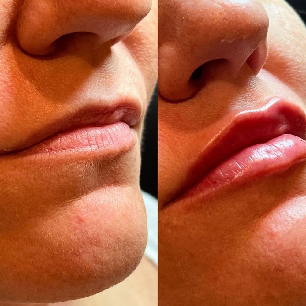lip-filler