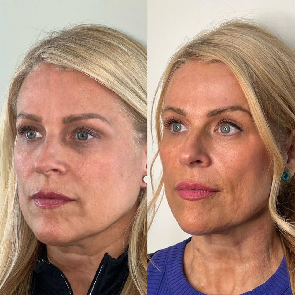 Sculptra-and-Filler-MOBO-Med-Spa