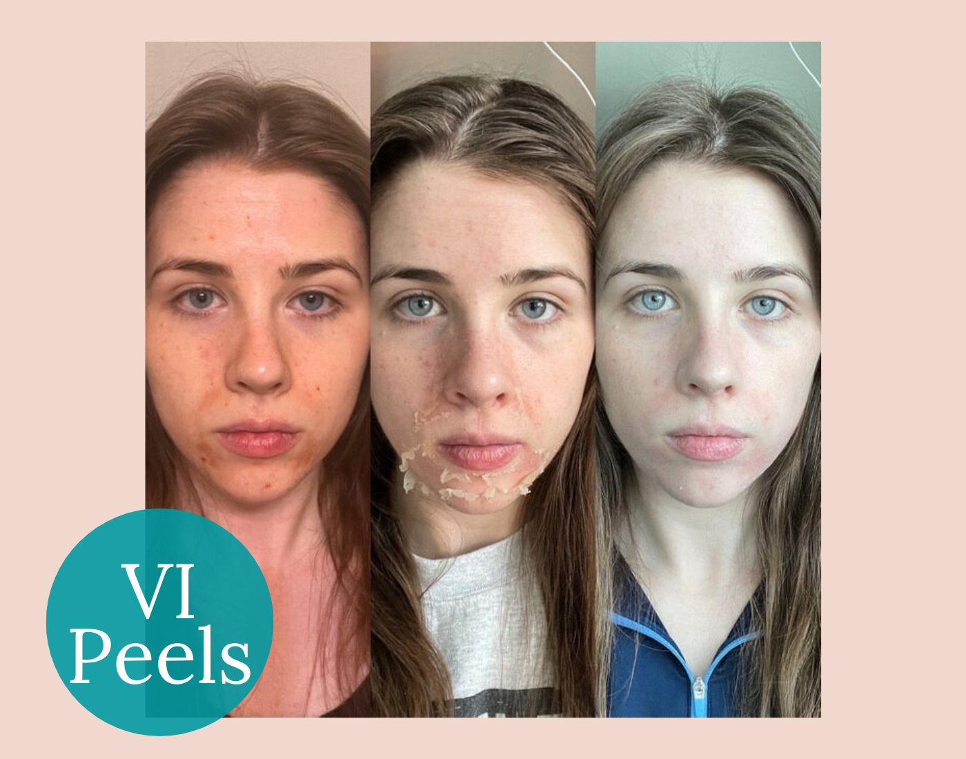 Why is Autumn the Best Time to Get a Peel?