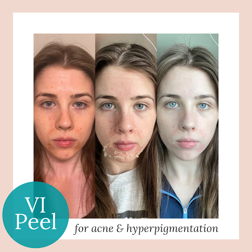 Why is Autumn the Best Time to Get a Peel?